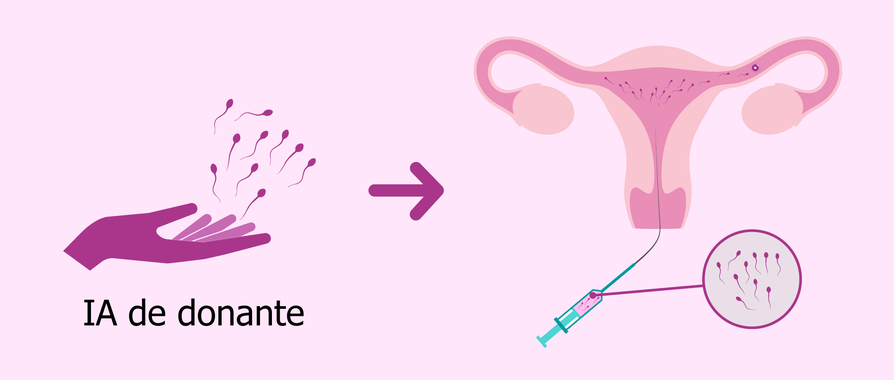 Inseminación Artificial (IAD)