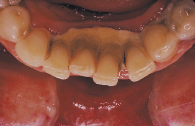 CÁLCULO SUPRAGINGIVAL