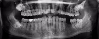 1895 Wilhelm Roentgen , a German physicist, discovers the x-ray . In ...