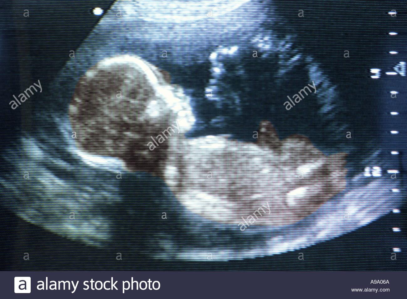 The average fetus at 7 months old.