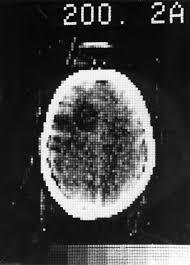 1971 Godfrey.Hounsfield Fabrica el Prototipo de escáner TC cerebral EMI ...