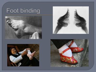 Picture of the results of Foot binding and what it looks like