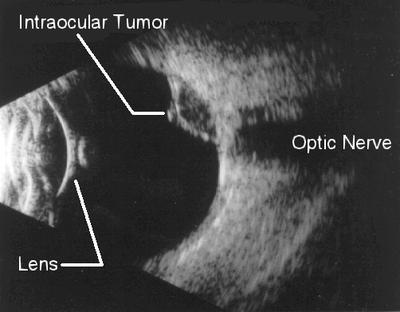 This is a picture that shows what eye cancer looks like in an ultra sound.