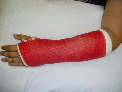 when i was 7 i broke my arm when i was riding my bike