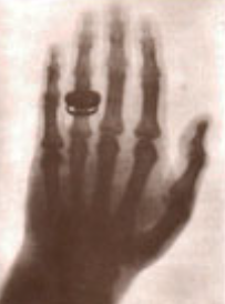 First X ray Hand Image