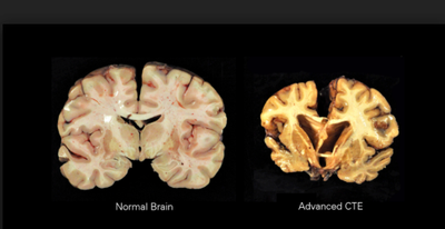 A Normal brain vs. a CTE brain