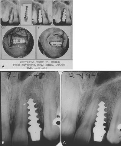 Alvin Strock inserts the first Vitallium dental screw implant ...