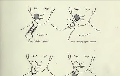 Tube Pedicle Invention
