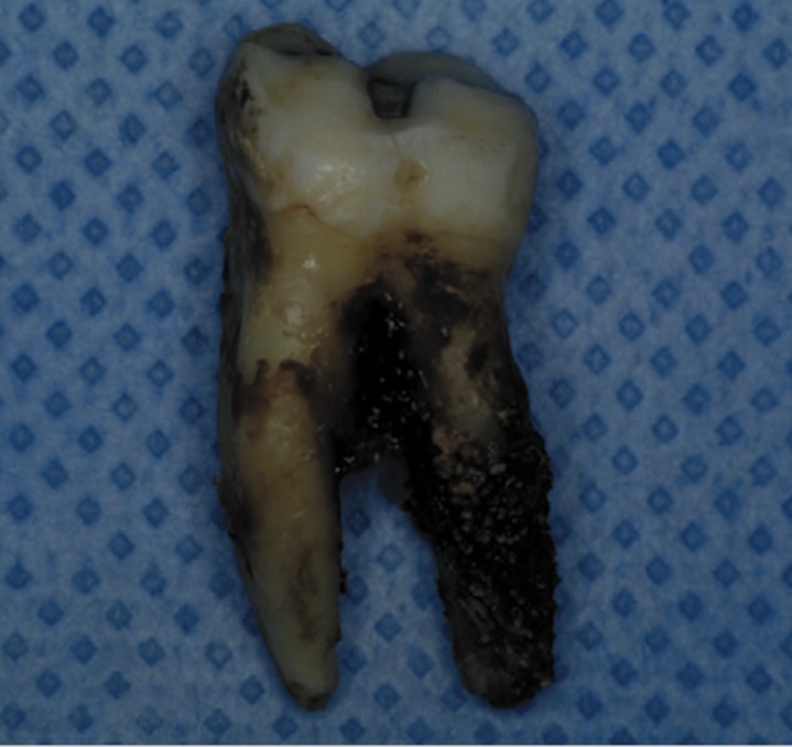 CÁLCULO INFRAGINGIVAL