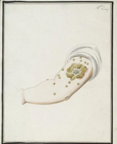 Smallpox Inoculation Monticello. “Disease and Inoculation in the 18th ...