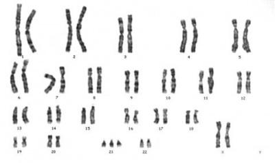 https://embryology.med.unsw.edu.au/embryology/index.php?title=Trisomy_21