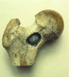 This is what the musket ball looks like when is has struck a bone.