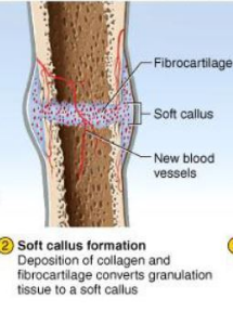 After the blood clot forms in about 2 weeks a soft callus will form ...