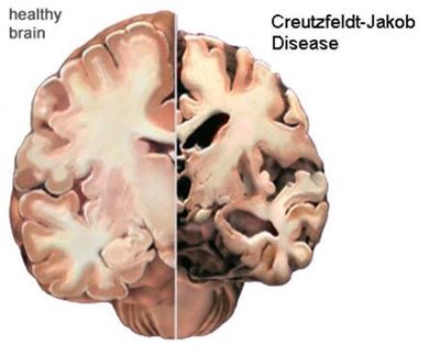 An image depicting the differences in the structure of a healthy brain ...