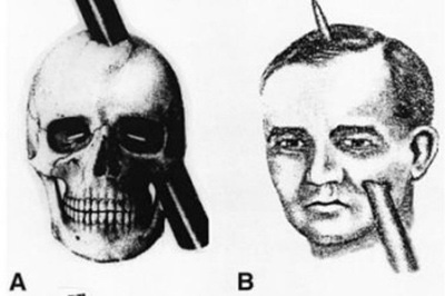 A: A sketch of Phineas Gage's skull with tamping iron going through it ...