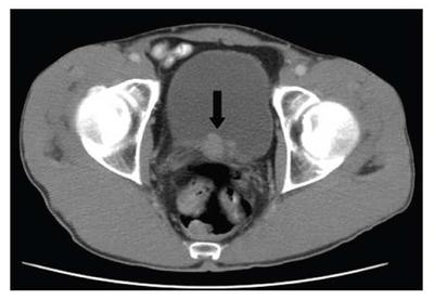 Bladder Cancer CT Scan